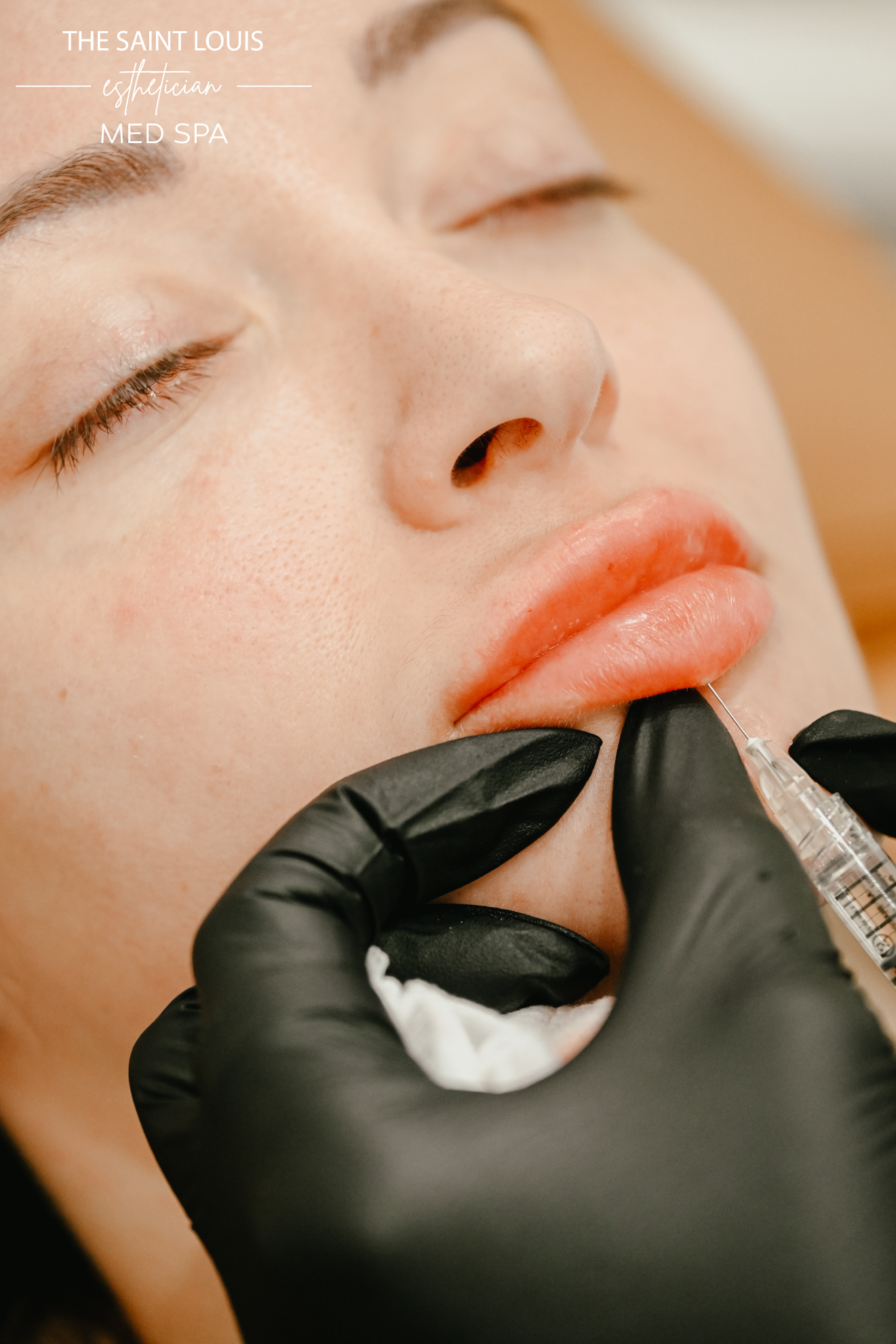 Lip Filler Dermal Filler 1 Syringe - The Saint Louis Med Spa